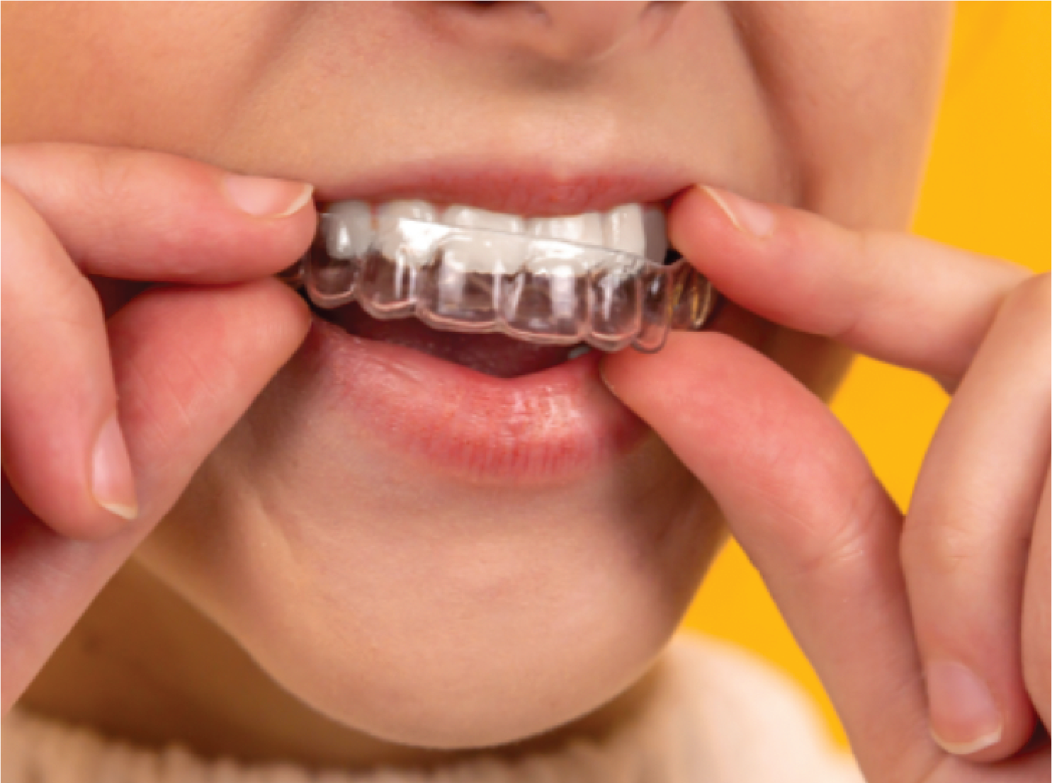 Reorder Your Customer Clear Retainers – Retainers Direct